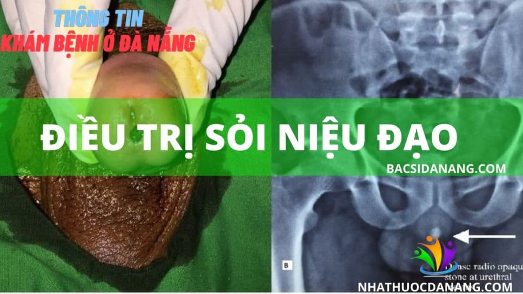 SỎI NIỆU ĐẠO: CHẨN ĐOÁN VÀ ĐIỀU TRỊ - Khám bệnh ở Đà Nẵng