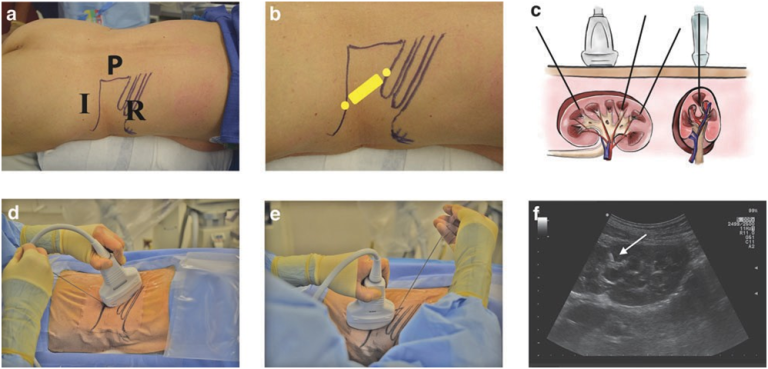 Ultrasound-Guided Mini-PCNL with Laser Lithotripsy: Minimally Invasive ...